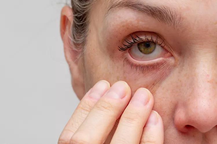 8 Reasons Why You Have Crusty Eyes, and What To Do About It